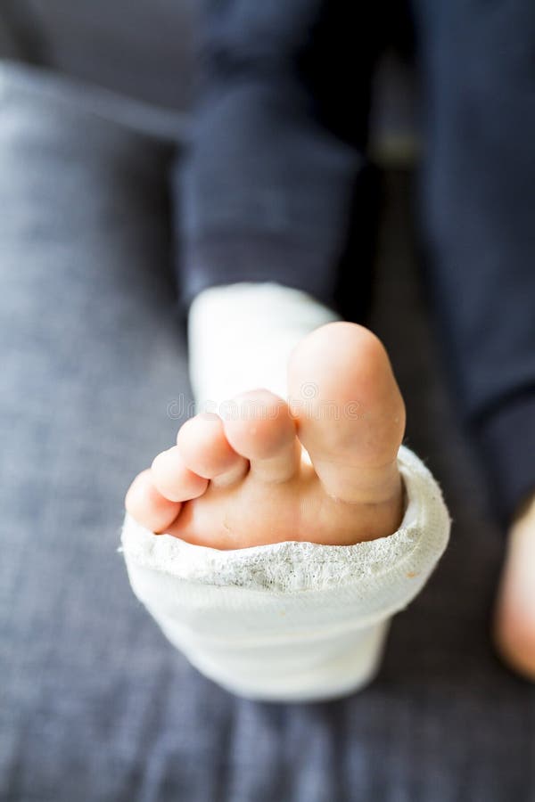 Broken Leg in a Cast during Treatment Stock Photo - Image of adult ...