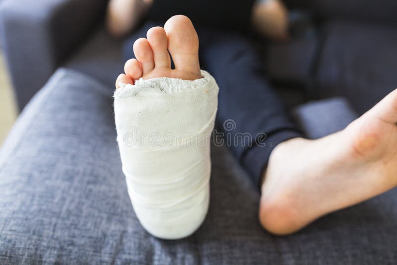 Broken Leg in a Cast during Treatment Stock Photo - Image of adult ...