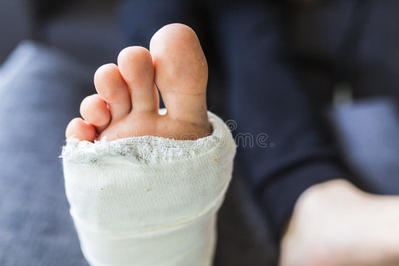 Broken Leg in a Cast during Treatment Stock Image - Image of closeup ...
