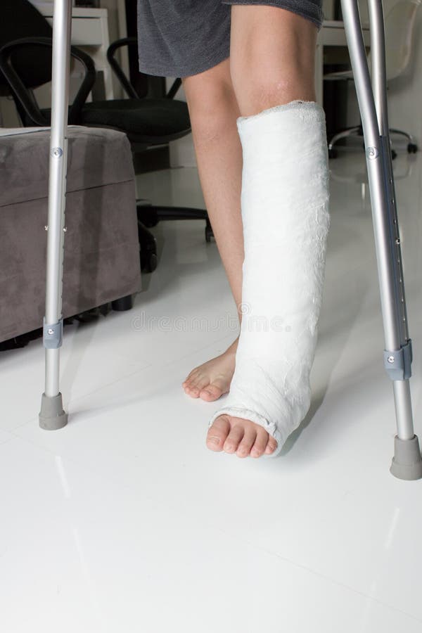 Detail Left Leg or in White Plaster Placed and Crutch. Stock Image ...
