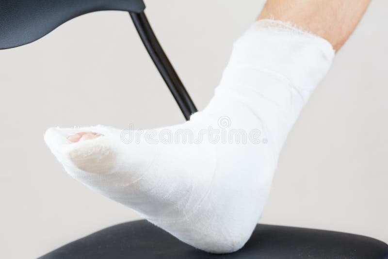 Leg Injury Plaster Bone Fracture, Foot Stock Image - Image of broken ...