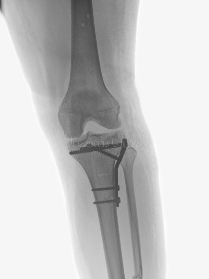 Broken leg after surgery stock image. Image of diagnostic - 66374219