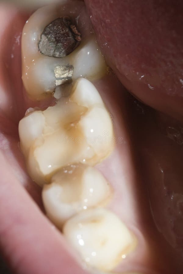 90+ Molar Free Stock Photos - StockFreeImages