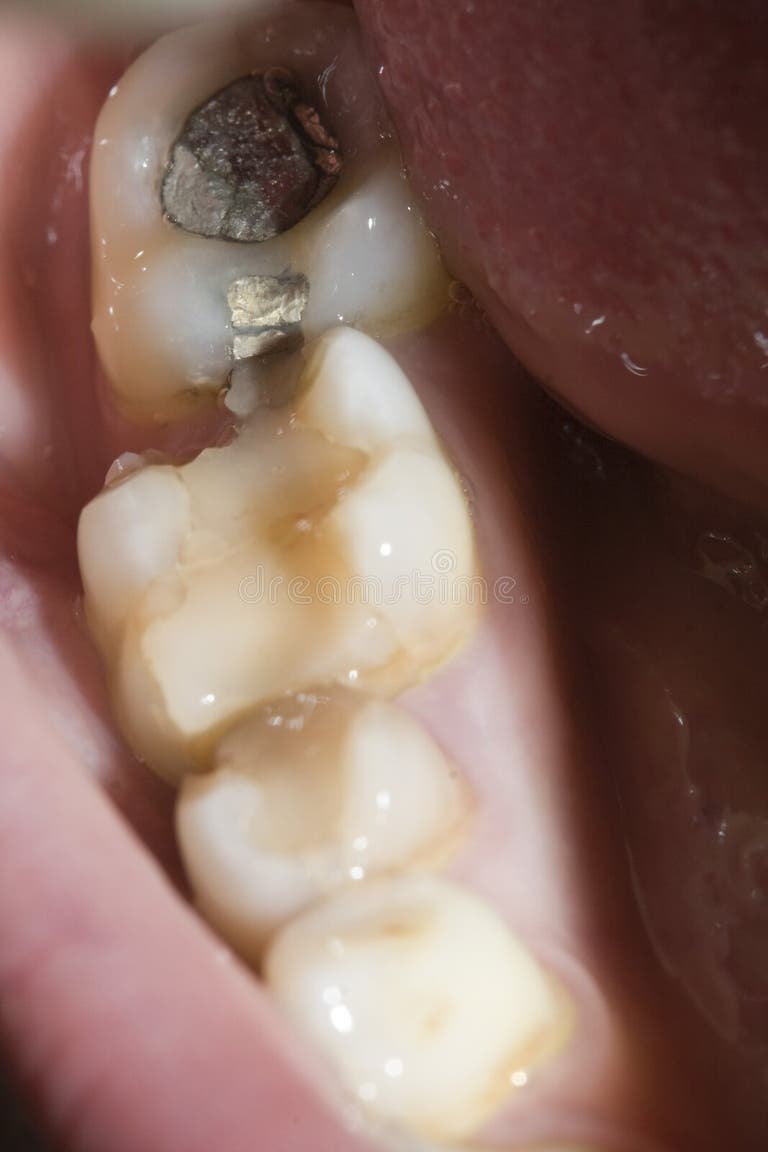 239 Broken Molar Stock Photos - Free & Royalty-Free Stock Photos from ...