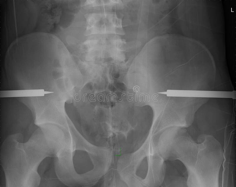 Broken pelvis stock photo. Image of hips, diagnostic - 12884690