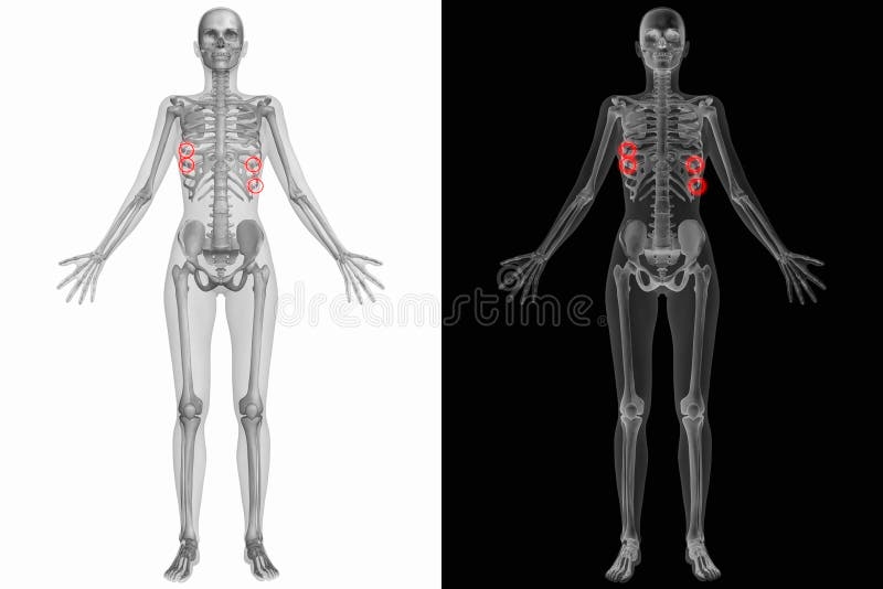 Broken Ribs stock illustration. Illustration of arms - 10003164