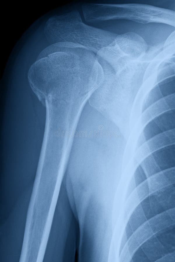 Normal Humerus X Ray