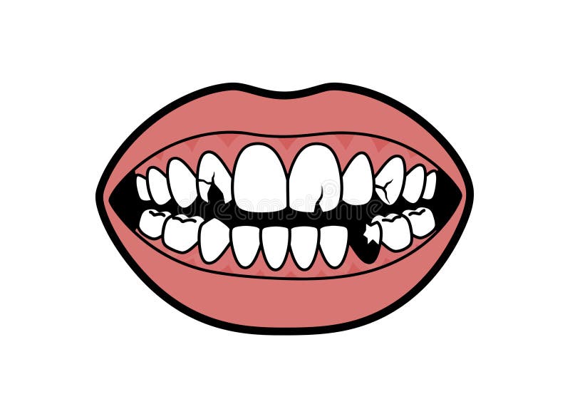 Broken teeth clip art stock vector. Illustration of vector - 364072919