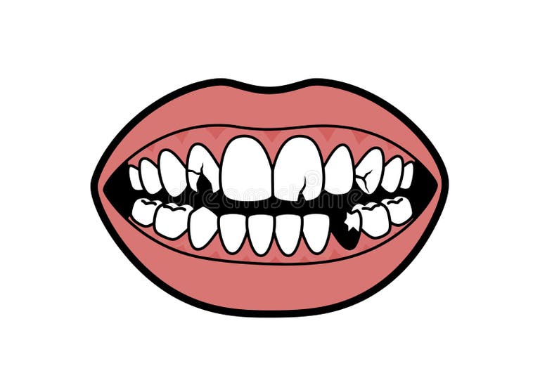 Broken teeth clip art stock vector. Illustration of vector - 364072919