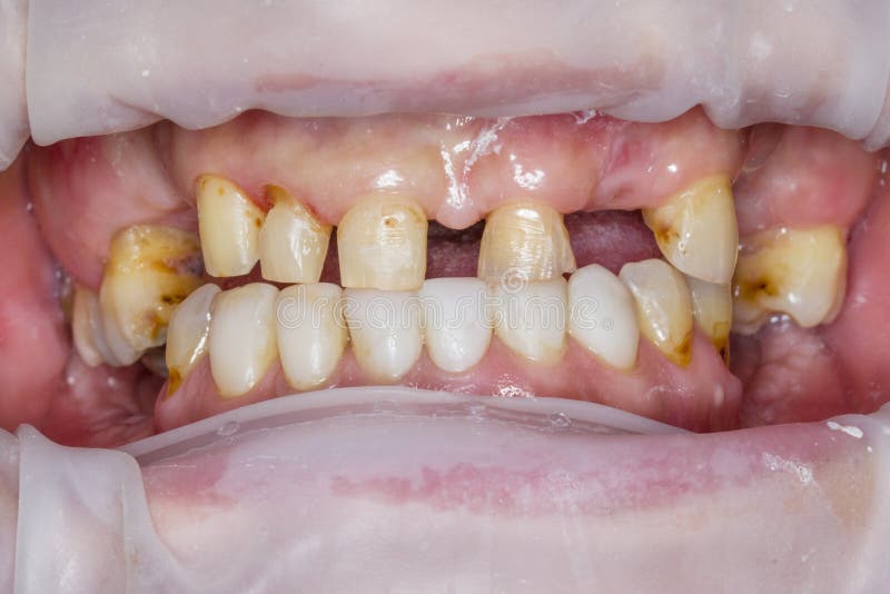Broken teeth stock image. Image of caries, gritted, broken - 244992239