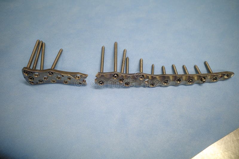 A Broken Titanium Plate Was Explanted in One Patient Stock Photo ...