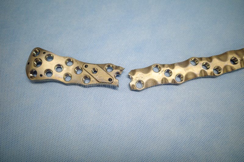 A Broken Titanium Plate Was Explanted in One Patient Stock Photo ...