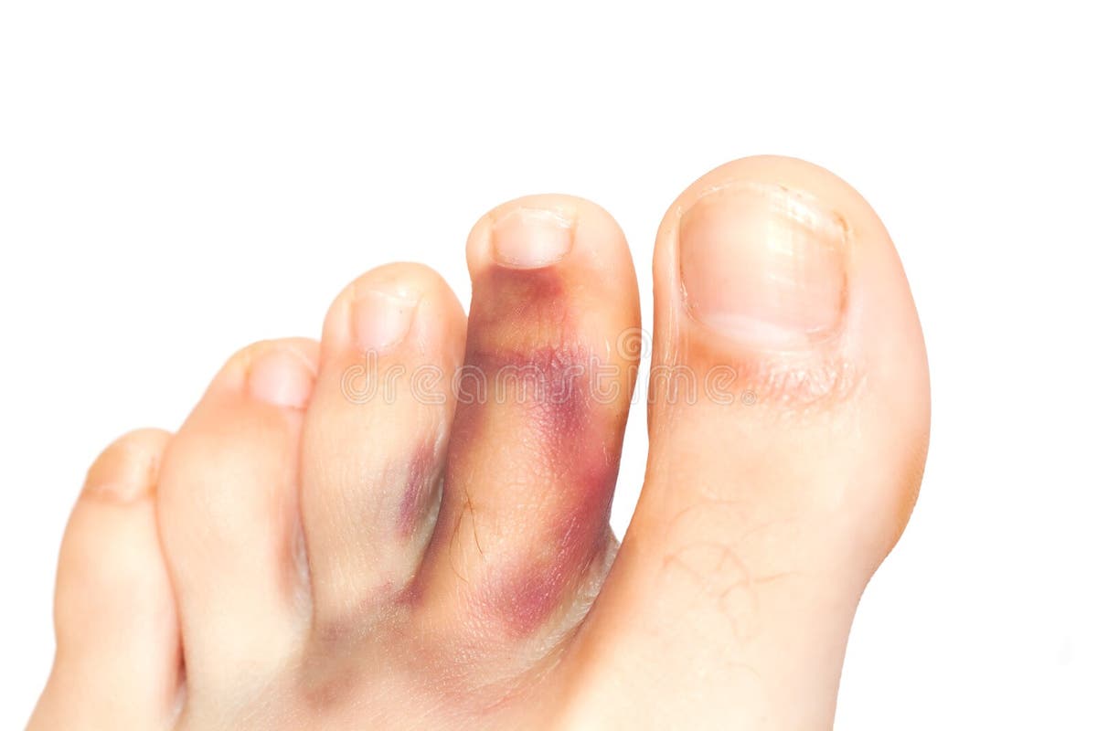 158 Swollen Red Toe Stock Photos - Free & Royalty-Free Stock Photos ...