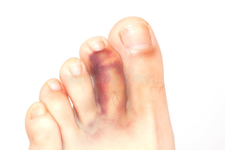 173 Swollen Red Toe Stock Photos - Free & Royalty-Free Stock Photos ...