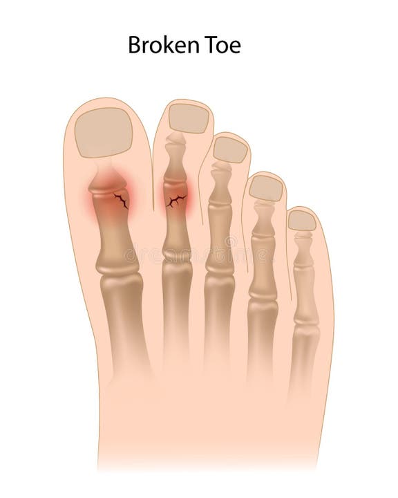 Big Toe Injury Stock Illustrations – 106 Big Toe Injury Stock ...