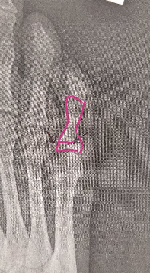 Dislocated Pinky Toe Xray