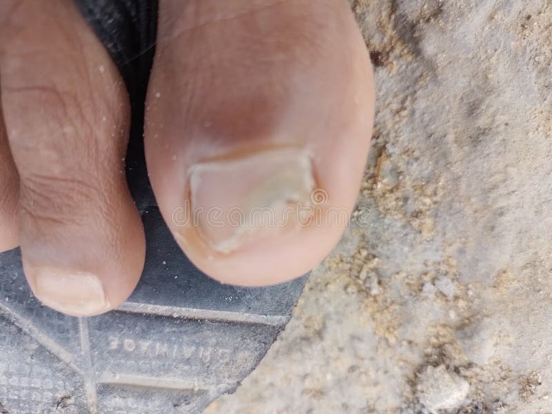 Broken Toe Nails stock image. Image of black, feet, sandals - 250095475