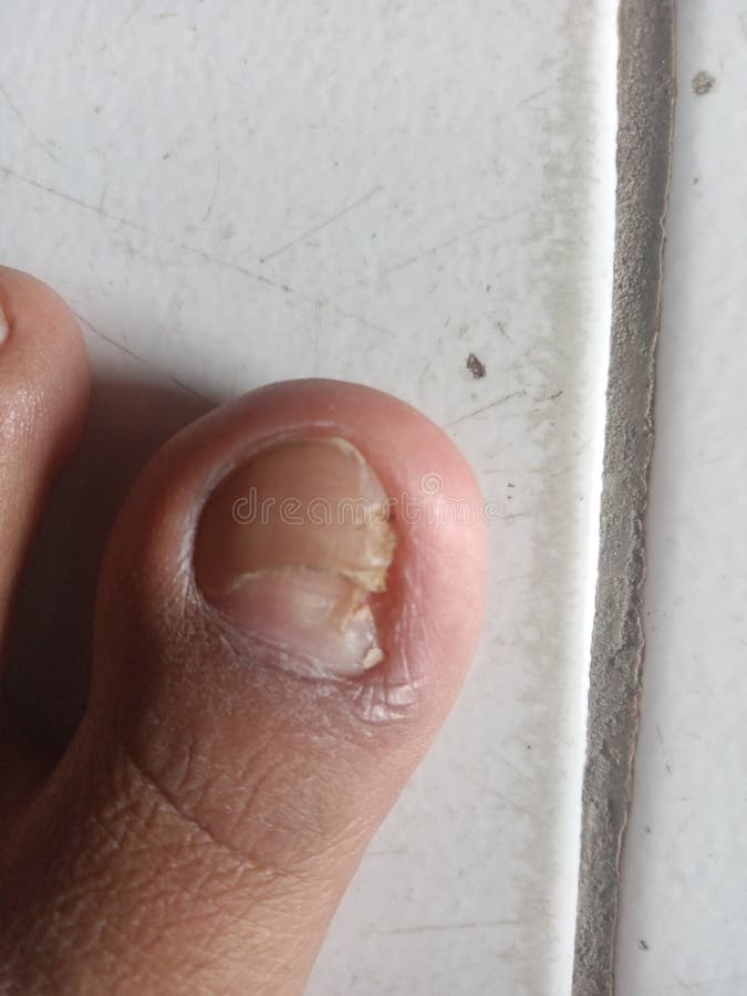 Broken toenail stock photo. Image of finger, broken - 231115102