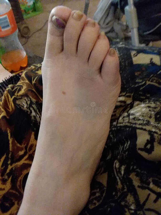 Broken Bruised Toe Over White Stock Photo - Image of healthcare, feet ...