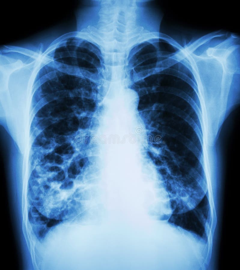 Bronchiectasis stock afbeelding. Image of cyste, beeld - 48513899
