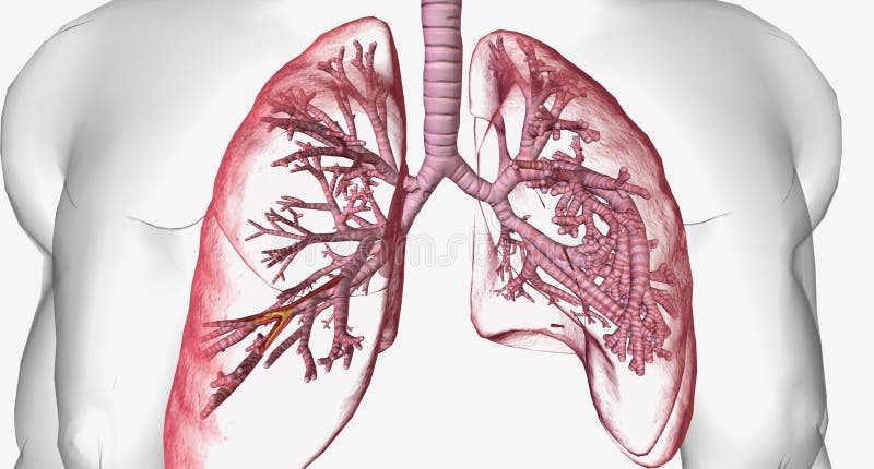 Bronchiectasis, Affecting the Lungs, Characterized by Inflamed Airways ...