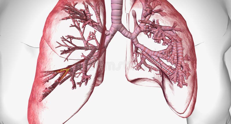 Bronchiectasis, Affecting the Lungs, Characterized by Inflamed Airways ...