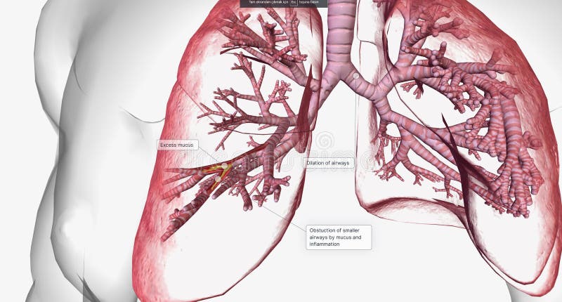 Bronchiectasis, Affecting the Lungs, Characterized by Inflamed Airways ...