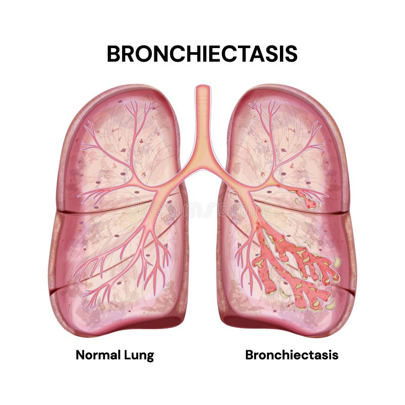 Bronchiectasis Labeled Diagram. Lung Disease. Normal Lung and ...