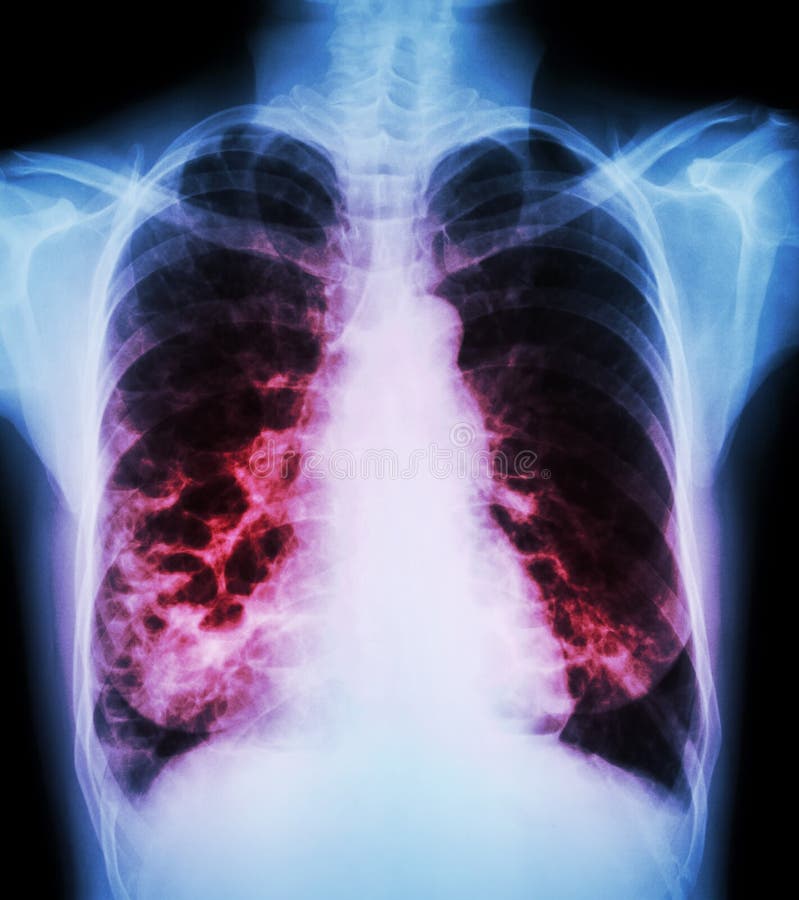 Bronchiectasis stock photo. Image of body, disease, chronic - 48513864