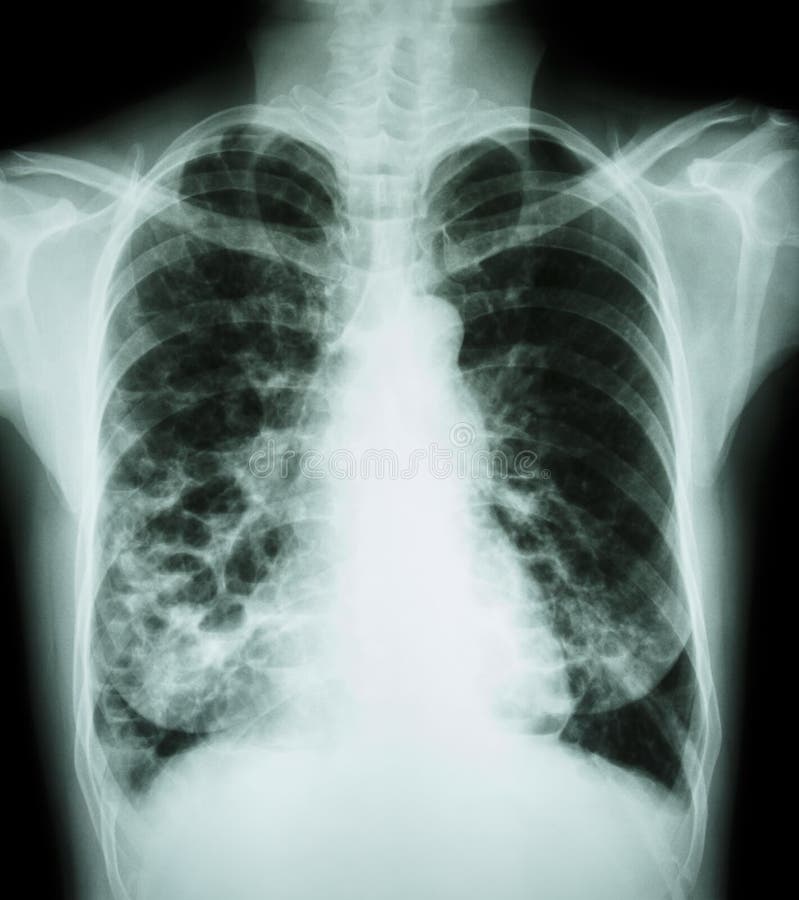Bronchiectasis stock photo. Image of human, communicable - 48514750