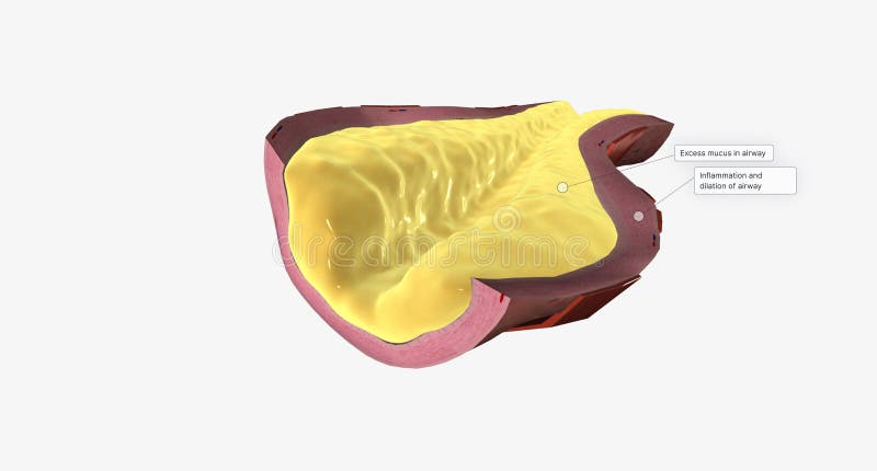 Bronchiectasis, Affecting the Lungs, Characterized by Inflamed Airways ...