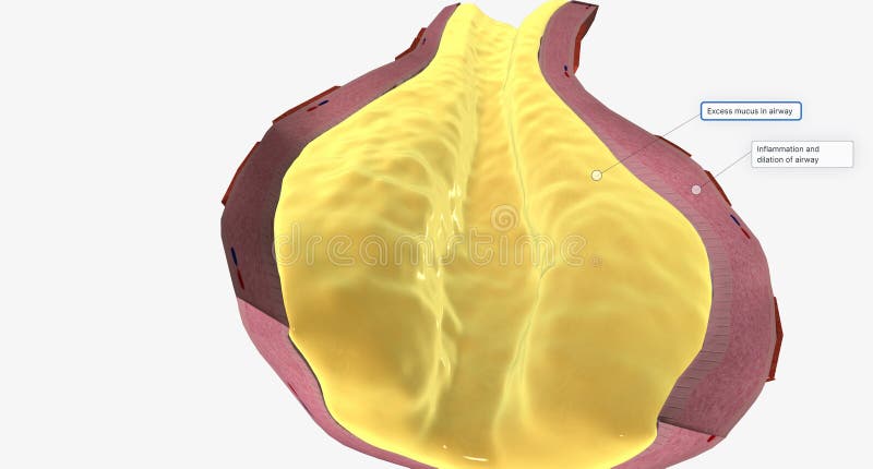Bronchiectasis, Affecting the Lungs, Characterized by Inflamed Airways ...