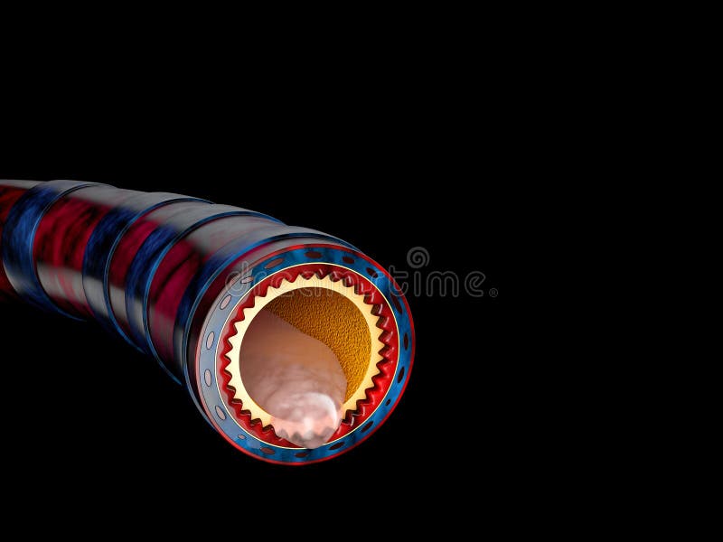 Bronchitis Anatomy, Mucus Secreted As a Chest Cold As a 3D Illustration ...