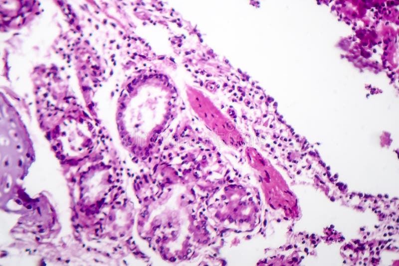 Bronchopneumonia, Light Micrograph Stock Image - Image of bronchitis ...