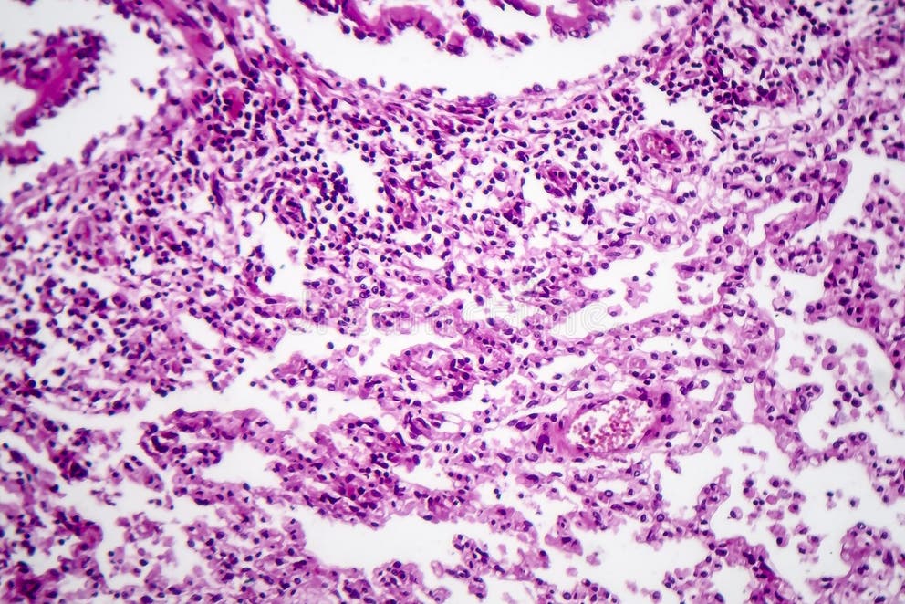 Bronchopneumonia, Light Micrograph Stock Image - Image of bronchitis ...