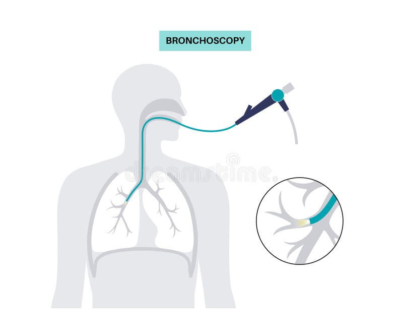 Bronchoscopy Procedure Concept Stock Illustration - Illustration of ...