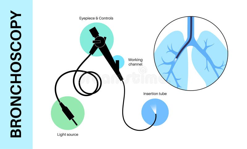 Bronchoscopy Procedure Concept Stock Vector - Illustration of ...