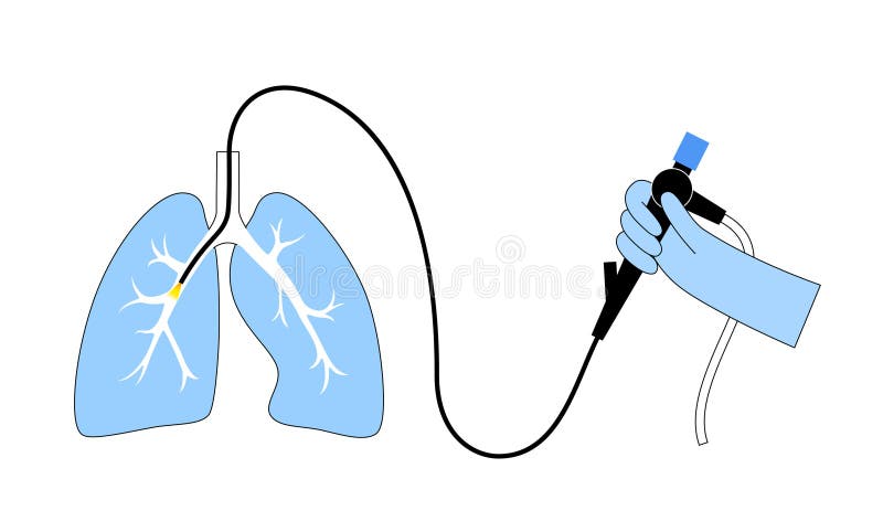 Bronchoscopy Vector Stock Illustrations – 162 Bronchoscopy Vector Stock ...