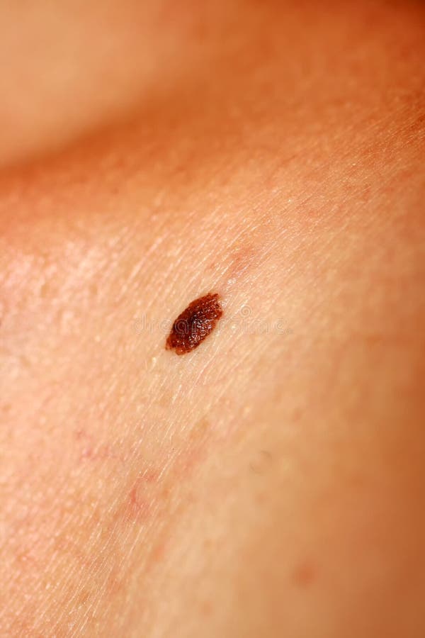 Removal of a Birthmark with a Laser. Brown Trace from Birthmark on Skin ...