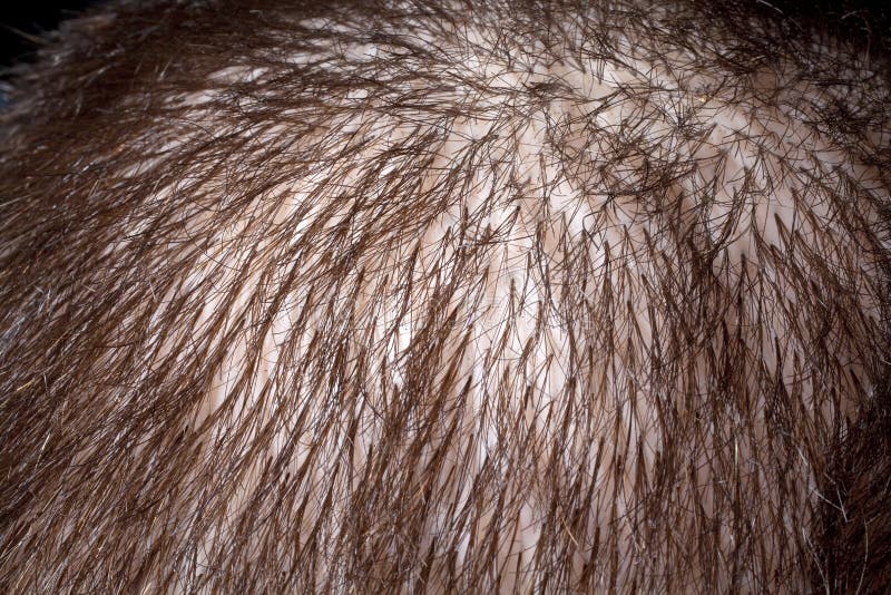 Schuppen Im Haar Flockige Kopfhaut Seborrhea Stockfoto - Bild von pilz ...