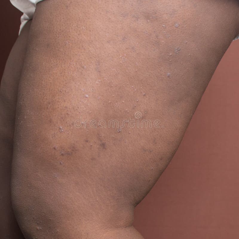 Brown Skin with Hyperpigmentation and Scarring from Eczema and Atopic ...