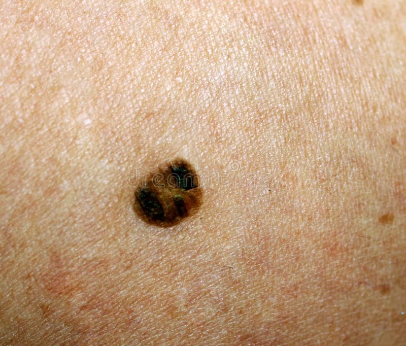 Brown Birthmark. Brown Mole Large Size Stock Image - Image of cancer ...