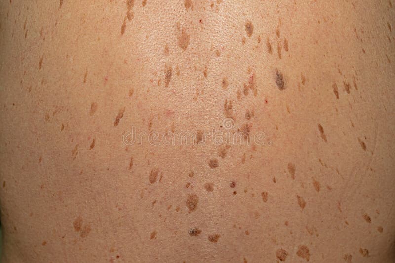 Brown Spots and Freckles on the Back of an Old Man. Skin Problems Stock ...