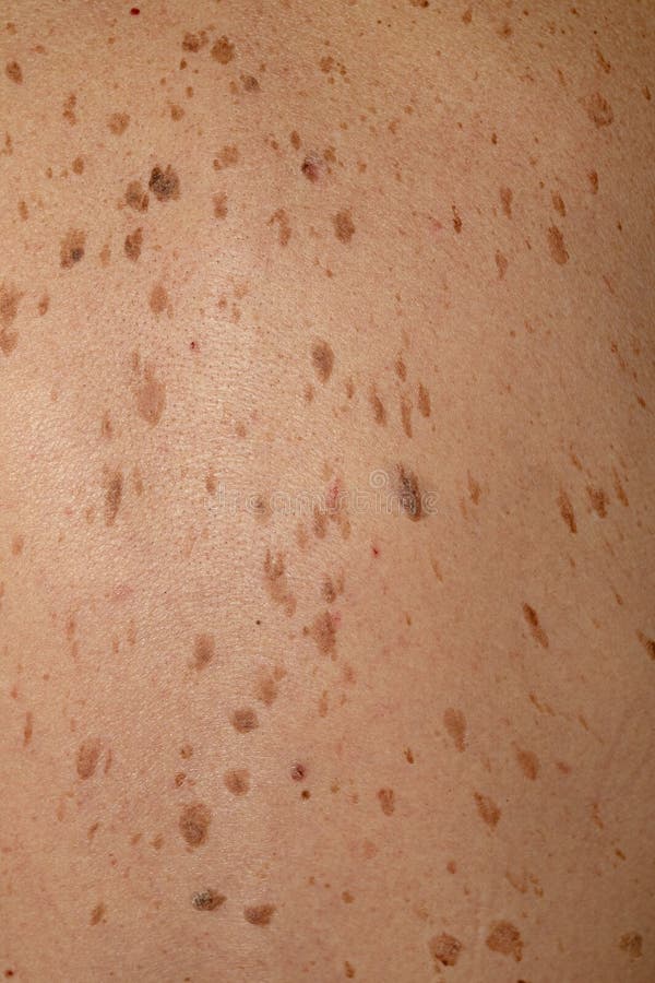 Brown Spots and Freckles on the Back of an Old Man. Skin Problems Stock ...