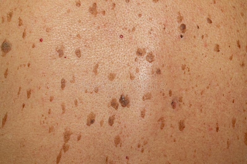 Brown Spots and Freckles on the Back of an Old Man. Skin Problems Stock ...