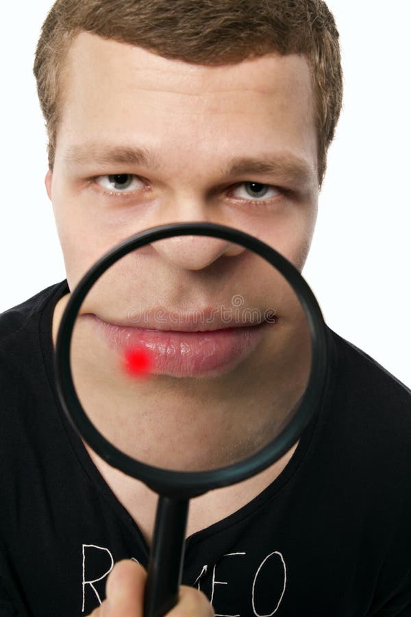 Brufolo sul labbro immagine stock. Immagine di grande - 53266057