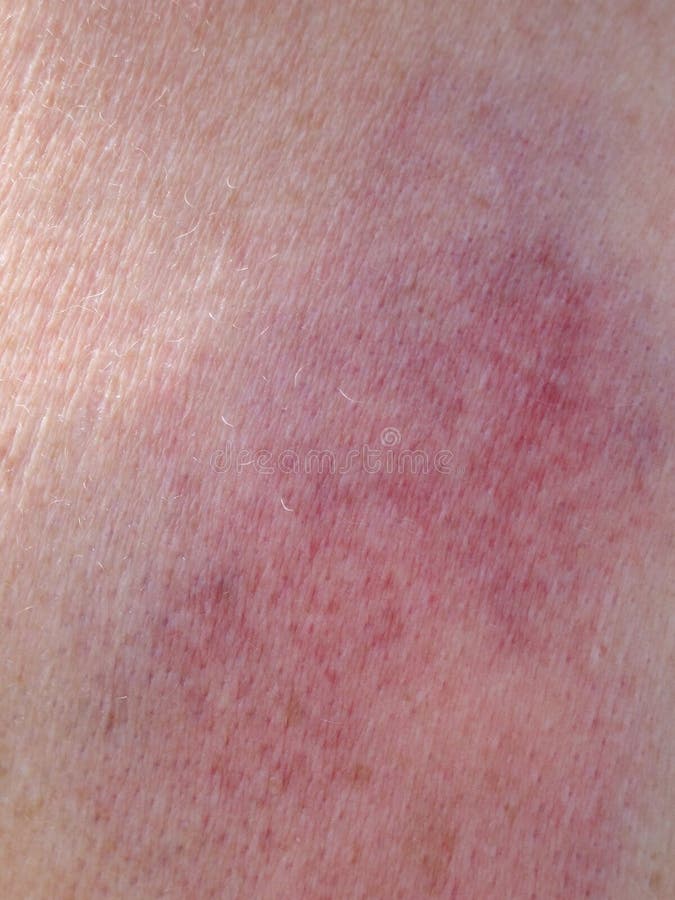 Bruise stock photo. Image of closeup, bruise, injury, accident - 2611768