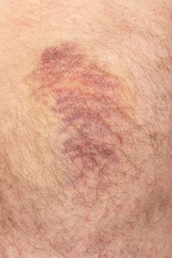 Bruise stock photo. Image of care, hurt, discoloration - 28335840