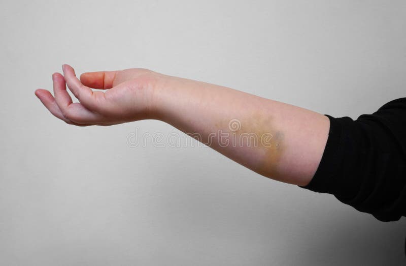 Bruise on the Inside of the Forearm. Stock Photo - Image of hematoma ...