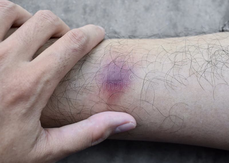 Mosquito Bite Cellulitis Stock Photos - Free & Royalty-Free Stock ...